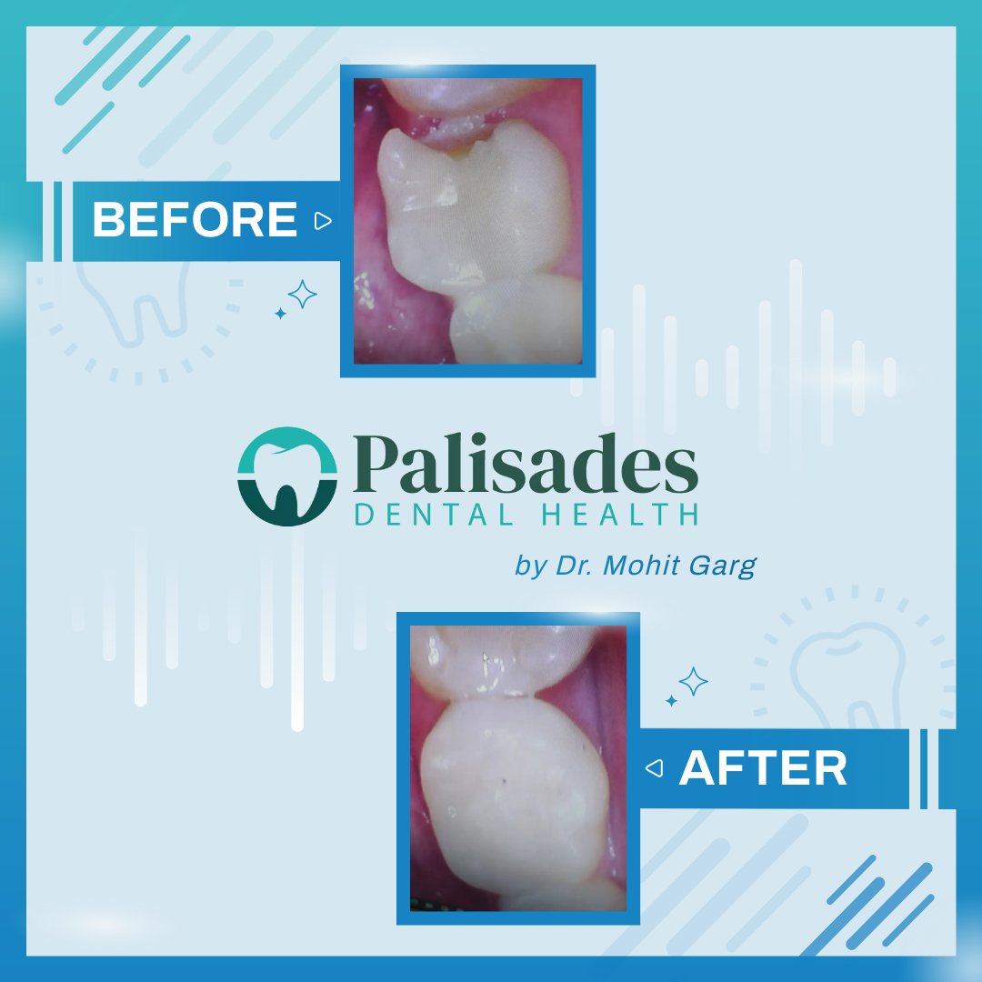 Before After By Dr. Mohit Garg - Palisades Dental Health Before After By Dr. Mohit Garg - Palisades Dental Health