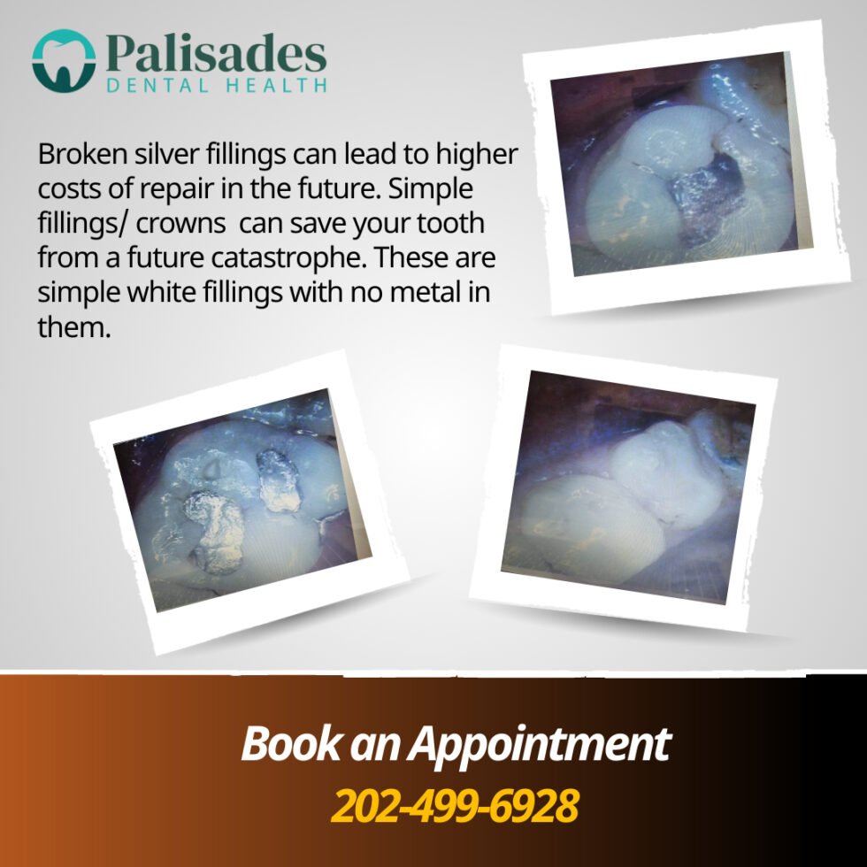 Broken Silver Fillings - Palisades Dental Health